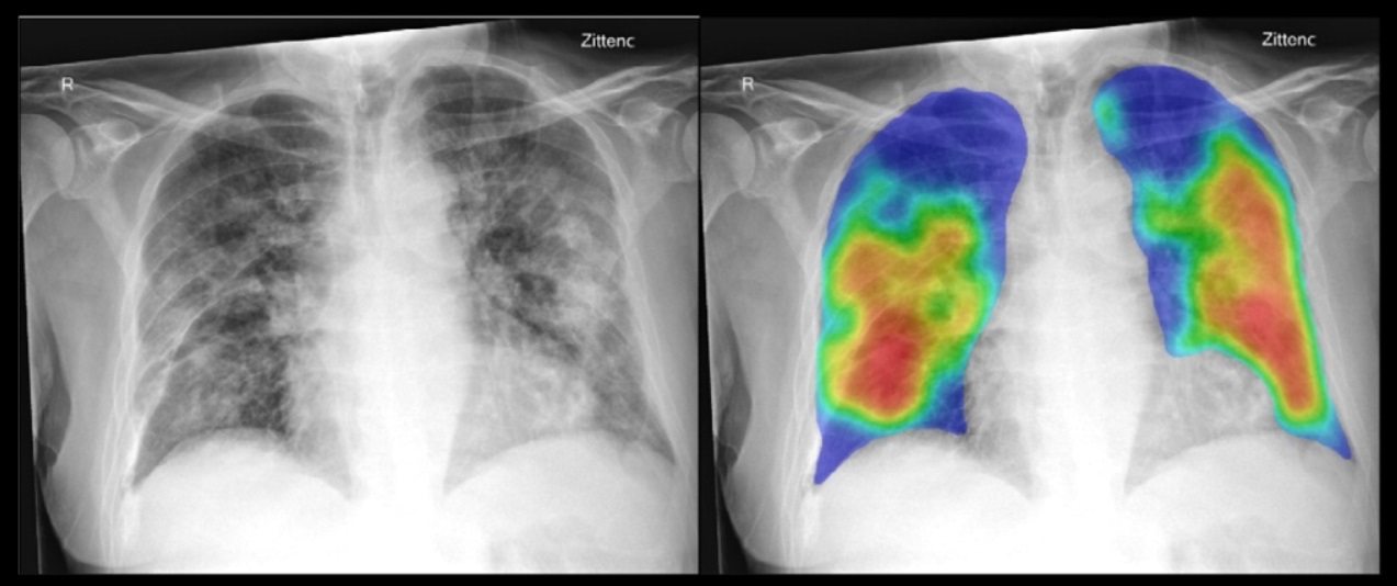 Nederlandse AI-software geschikt voor beoordelen longfoto's COVID-19 ...